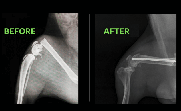 Salter Harris Fracture